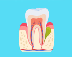 เหงือกเป็นหนอง สาเหตุและวิธีแก้ปัญหา - SKT Dental Center